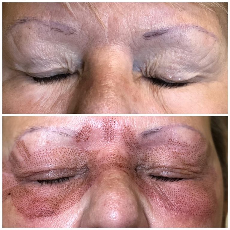 Plasma Fibroblast Treatment | Skin Tightening Charlotte NC